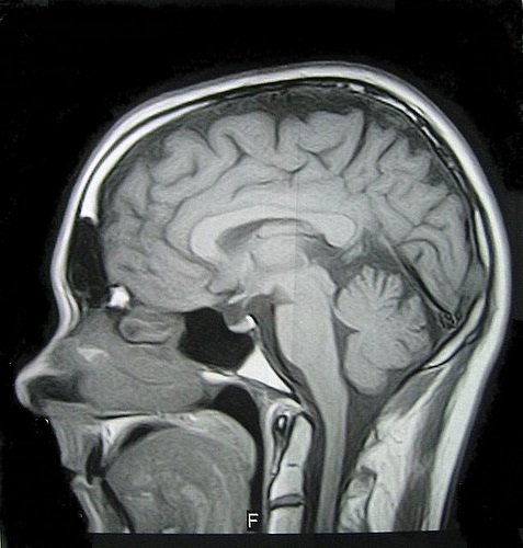 Six Ways to Keep Your Brain from Shrinking - Heal Naturally